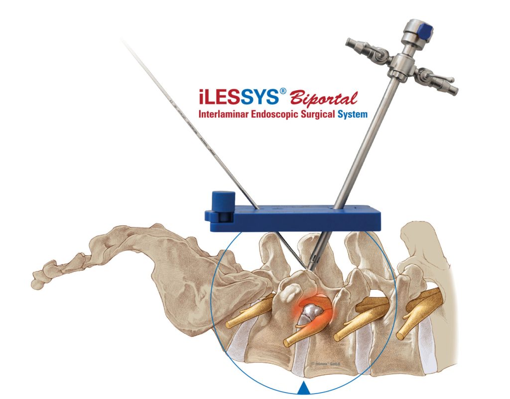 joimax® Launches New iLESSYS® Biportal Interlaminar Endoscopic Surgical System - Herald-Standard